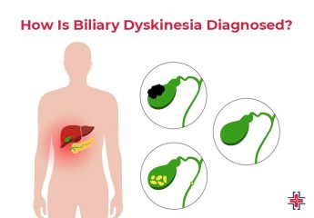 Understanding Biliary Dyskinesia: Symptoms, Causes, Complications, And ...