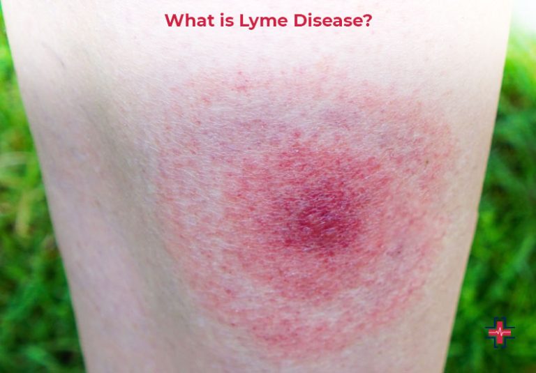 Understanding Lyme Disease: A Top-Down Overview | ER of Mesquite